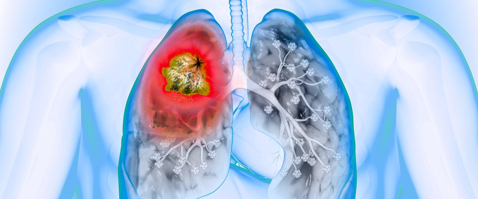 Cancerul pulmonar: Diagnostic și tratament – Chișinău